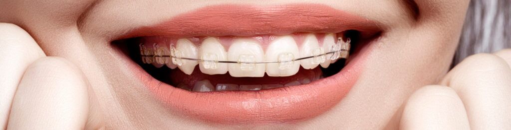 Fast Braces - Prestwood Dental Health Centre